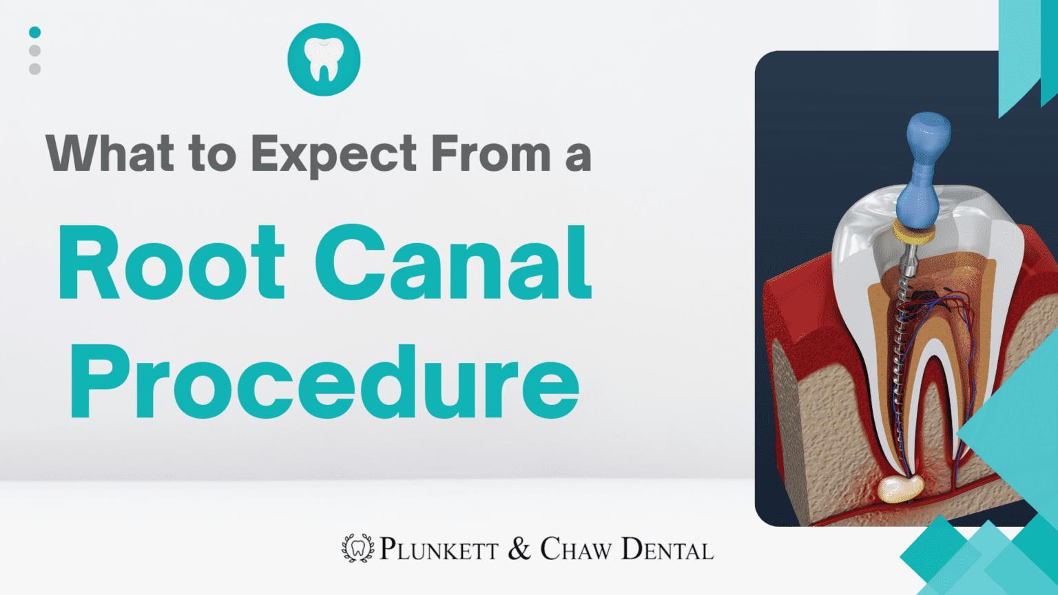 What to Expect from a Root Canal | Root Canal Procedure